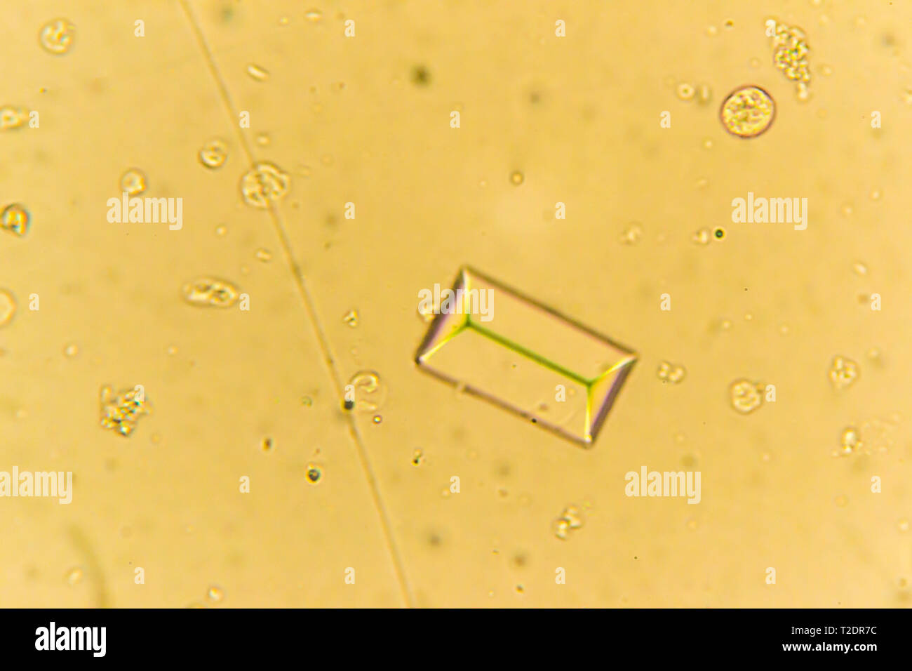 urine crystals at microscope Stock Photo - Alamy