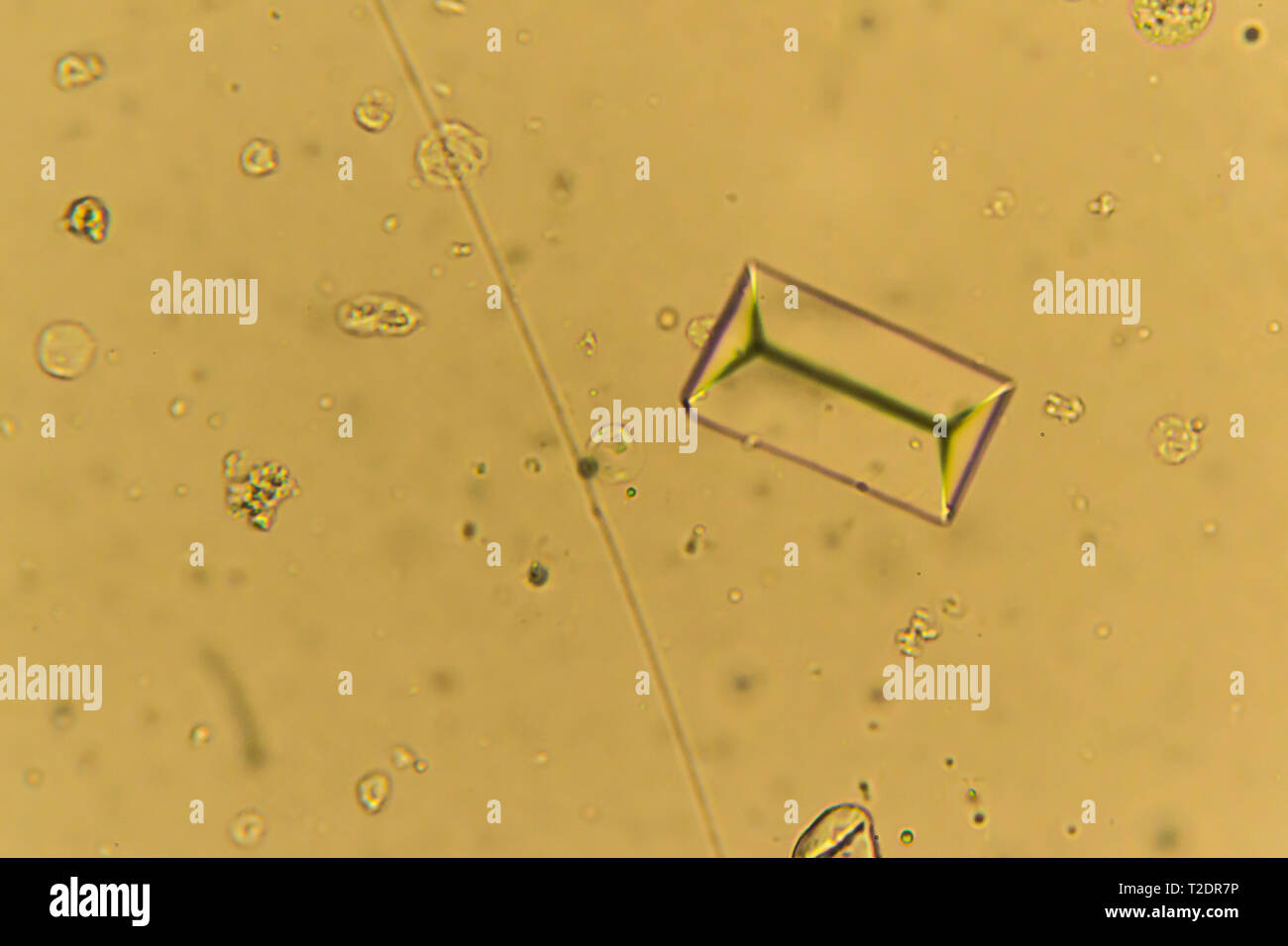 urine crystals at microscope Stock Photo - Alamy