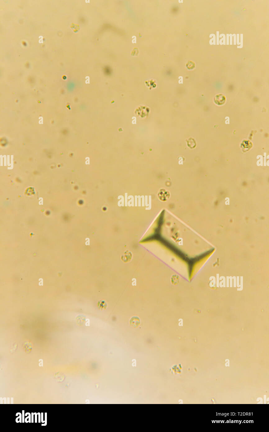 urine crystals at microscope Stock Photo - Alamy