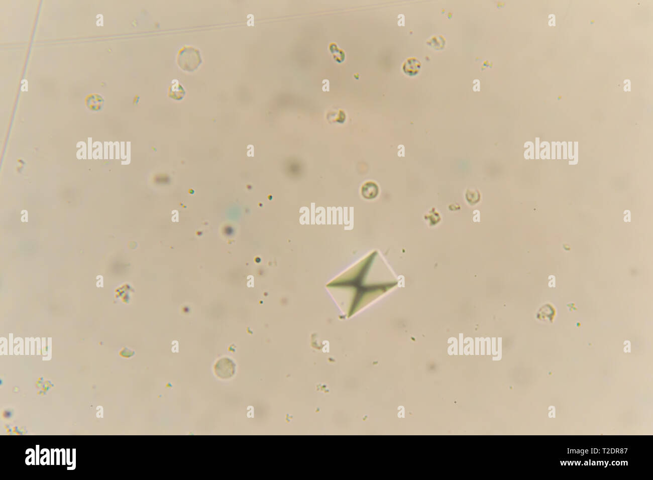 urine crystals at microscope Stock Photo - Alamy