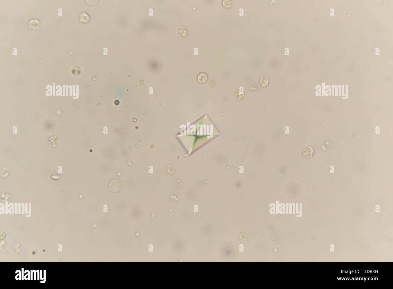 urine crystals at microscope Stock Photo - Alamy