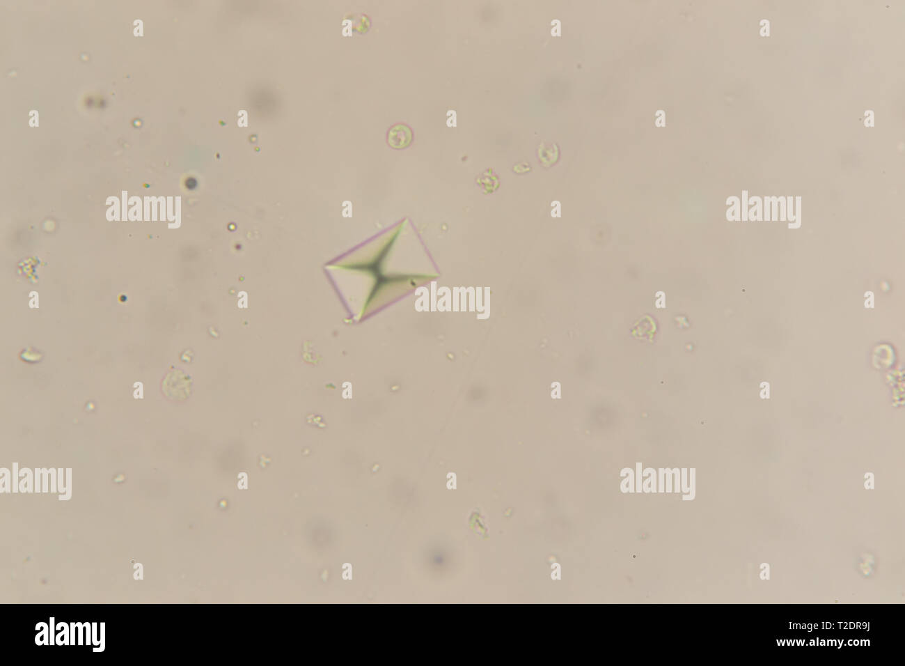 urine crystals at microscope Stock Photo - Alamy