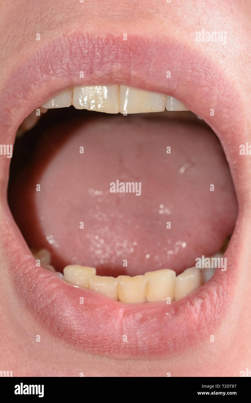 Rotten Teeth High Resolution Stock Photography and Images - Alamy
