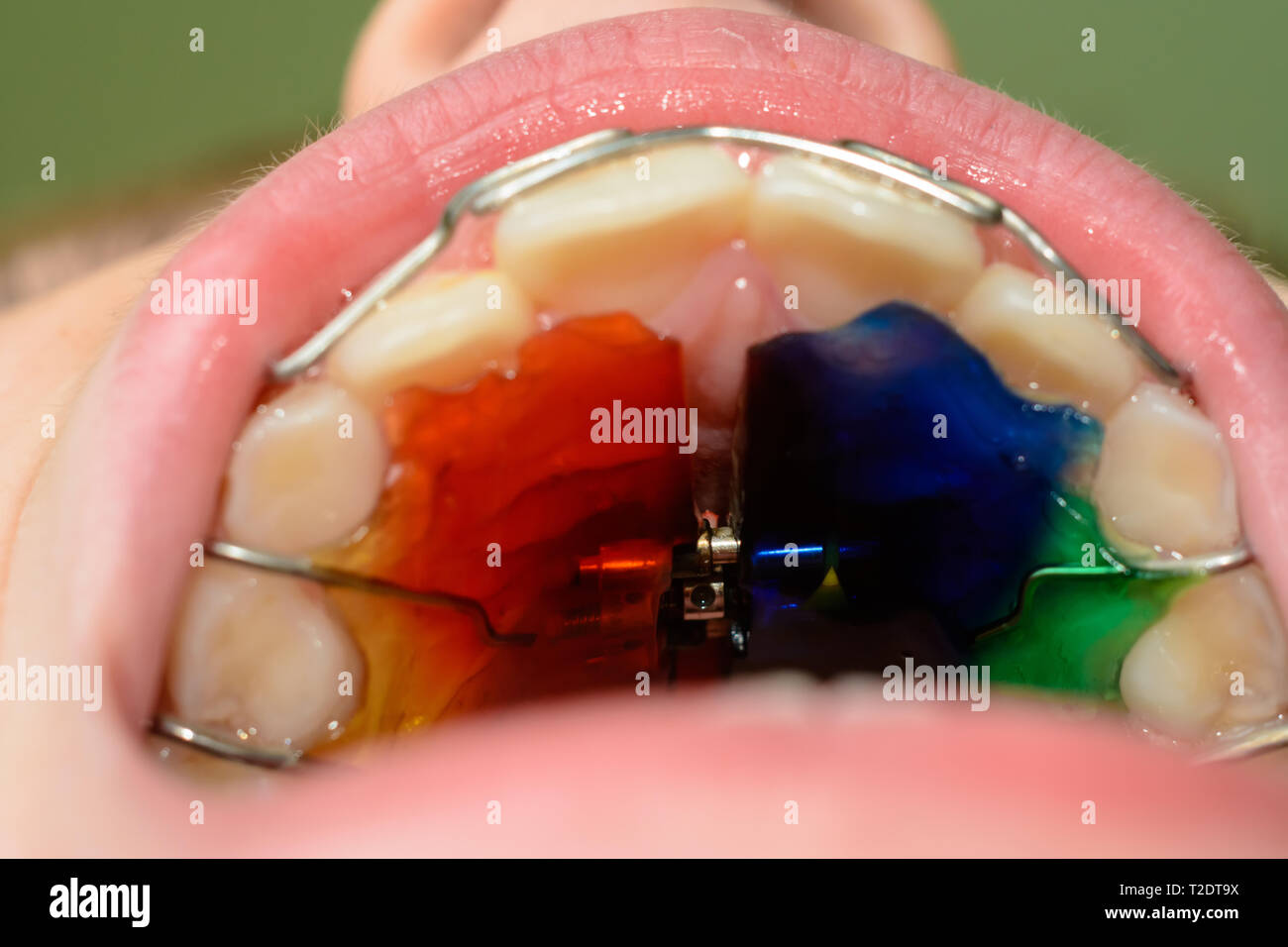 Close-up of a metal plate in the mouth on the teeth of a little boy ...