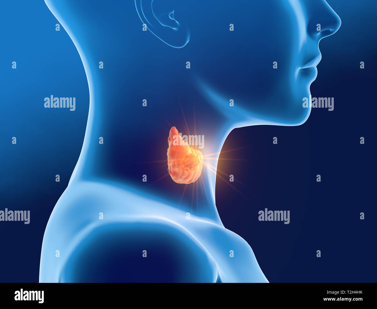 Thyroid cancer hi-res stock photography and images - Alamy