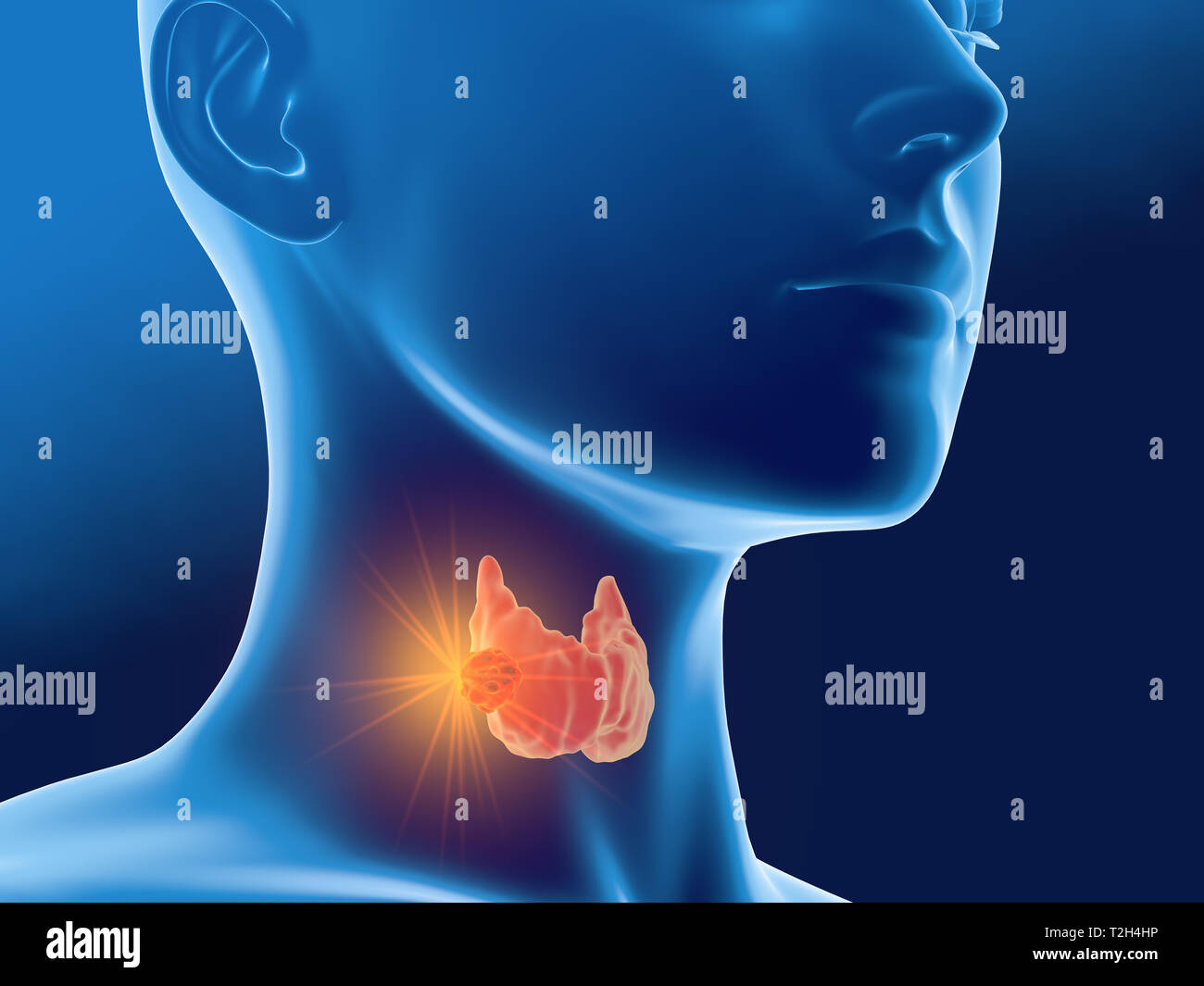 Thyroid cancer hi-res stock photography and images - Alamy