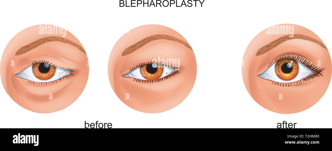 vector illustration of blepharoplasty of the overhanging eyelid and ...