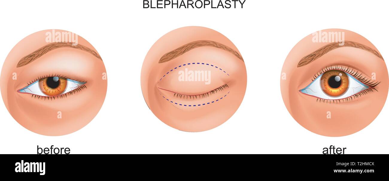 vector illustration of blepharoplasty of the Asian eyelid Stock Vector ...
