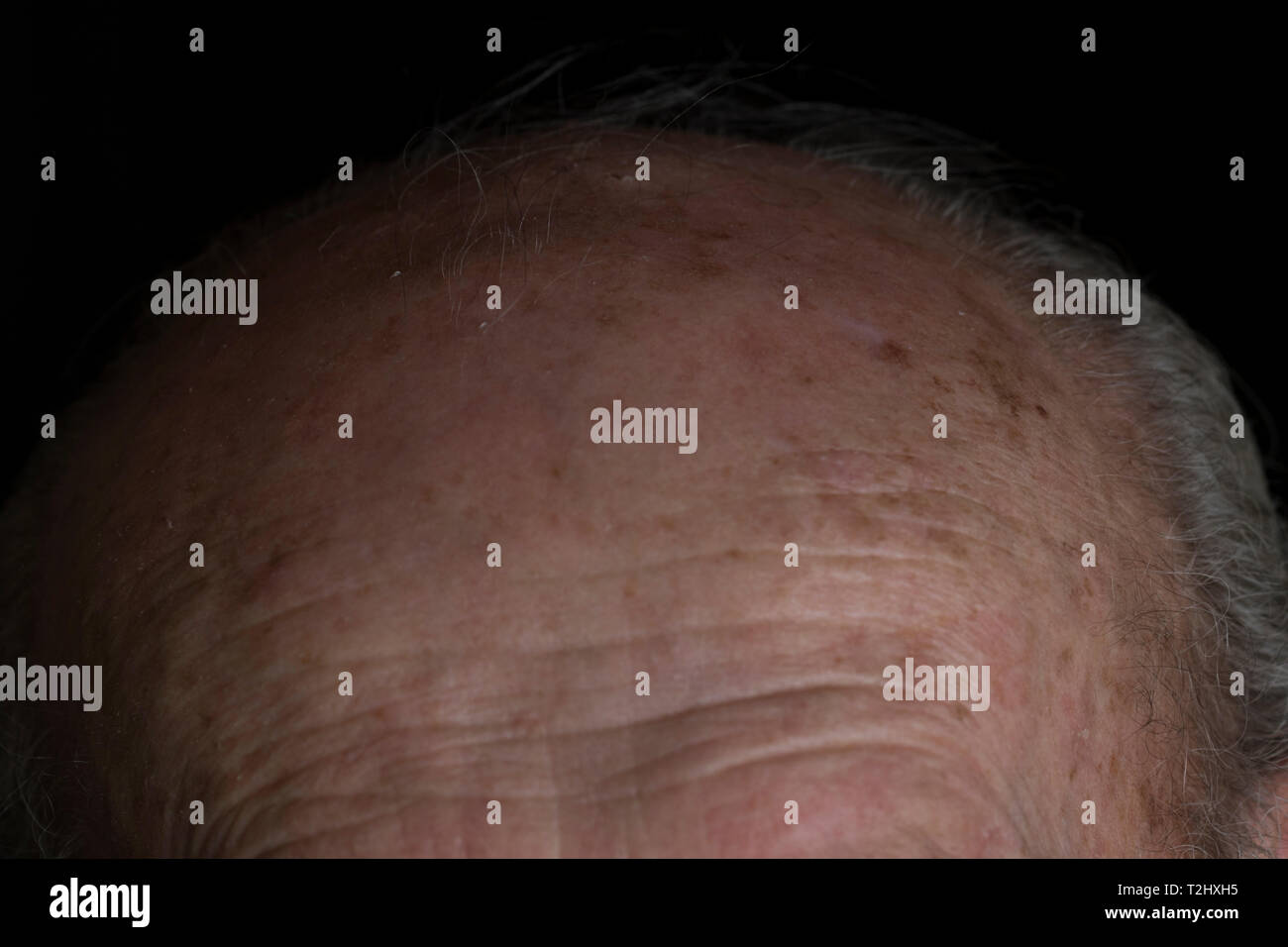 Health and medicare concept with close up of forehead with sun damage ...