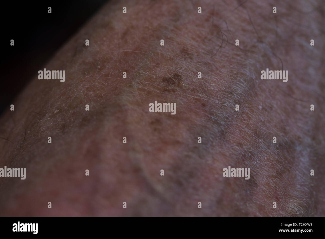Skin discoloration hi-res stock photography and images - Alamy