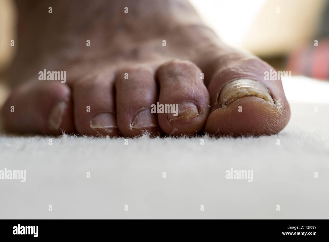 Damaged nail bed hi-res stock photography and images - Alamy