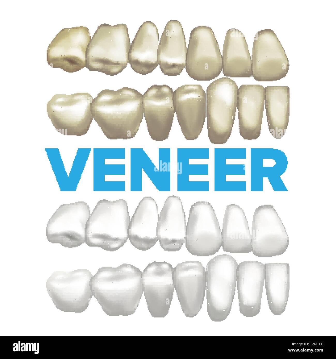 Veneer Vector. Dental Veneer Concept. Medical Banner Design Element. Tooth Before After ...