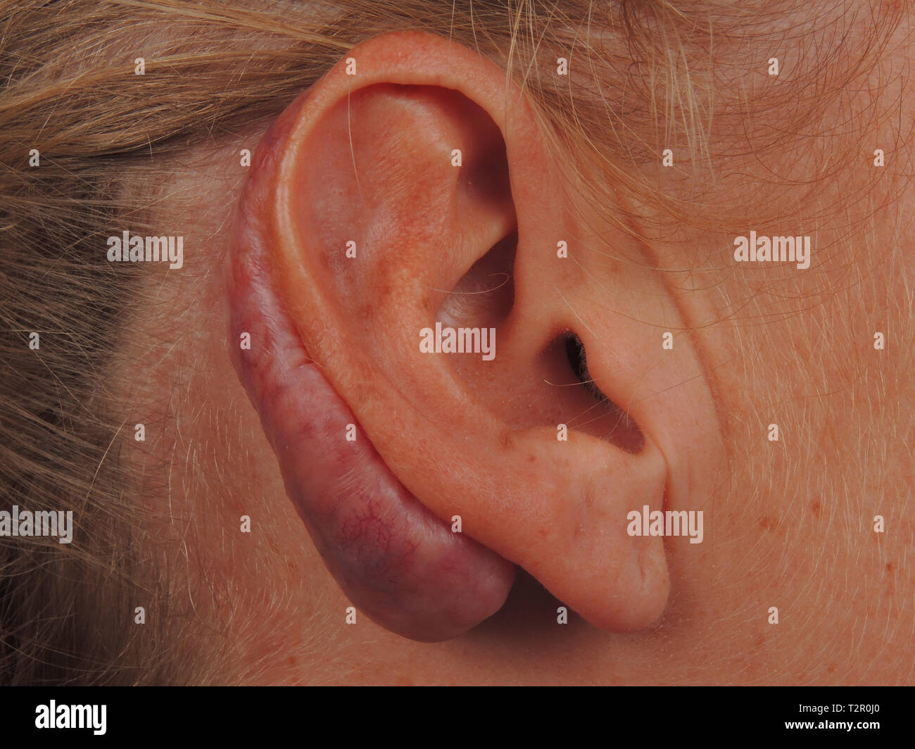 Ear scar hi-res stock photography and images - Alamy