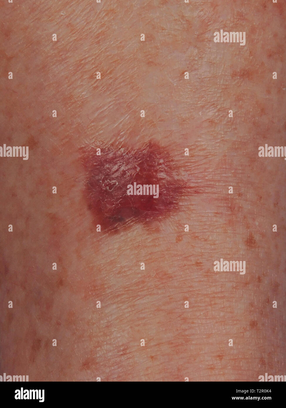 Squamous cell carcinoma lower leg hi-res stock photography and images ...