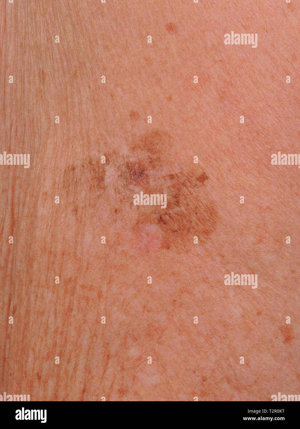 Melanoma Of Dubreuilh High Resolution Stock Photography and Images - Alamy
