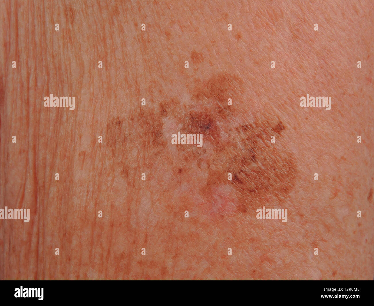 Melanoma of dubreuilh hi-res stock photography and images - Alamy