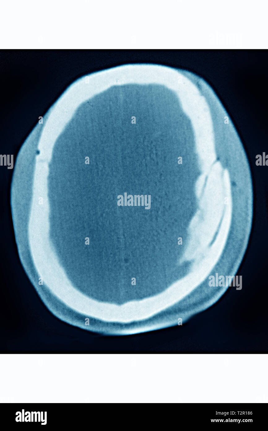 Skull fracture ct hi-res stock photography and images - Alamy