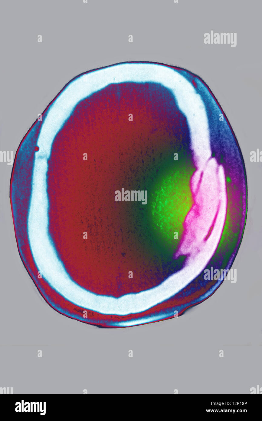 Skull fracture ct hi-res stock photography and images - Alamy