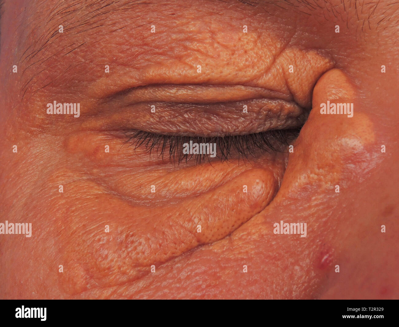 Xanthelasma hi-res stock photography and images - Alamy