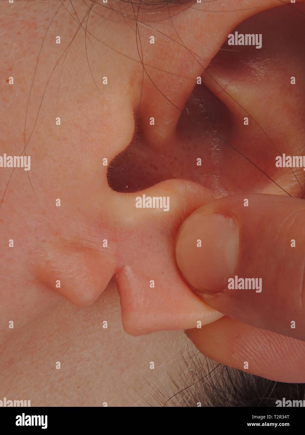 Split ear lobe Stock Photo - Alamy