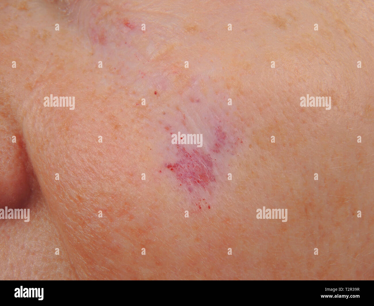 Benign capillary hemangioma fibrosis Stock Photo - Alamy
