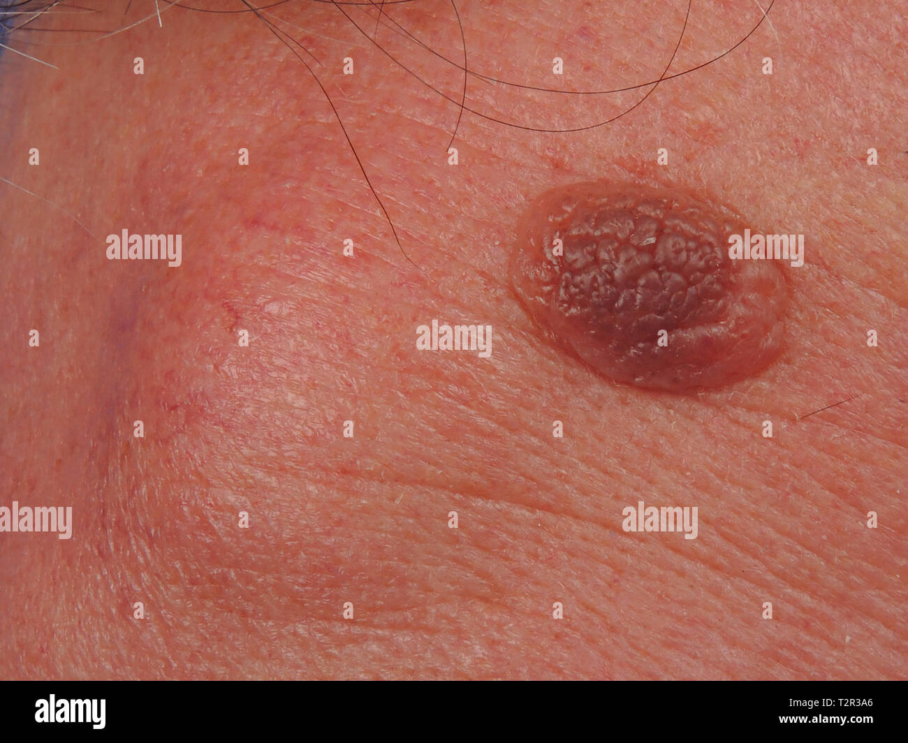 Nevus verrucosus and lipoma Stock Photo - Alamy