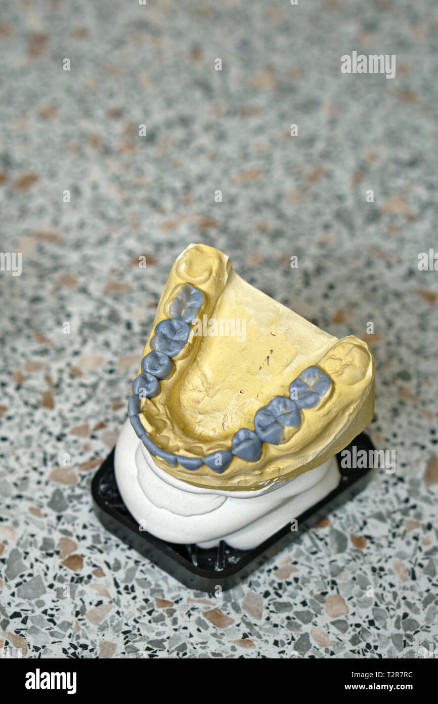 Dental impressions of teeth for manufacture of prostheses and ...