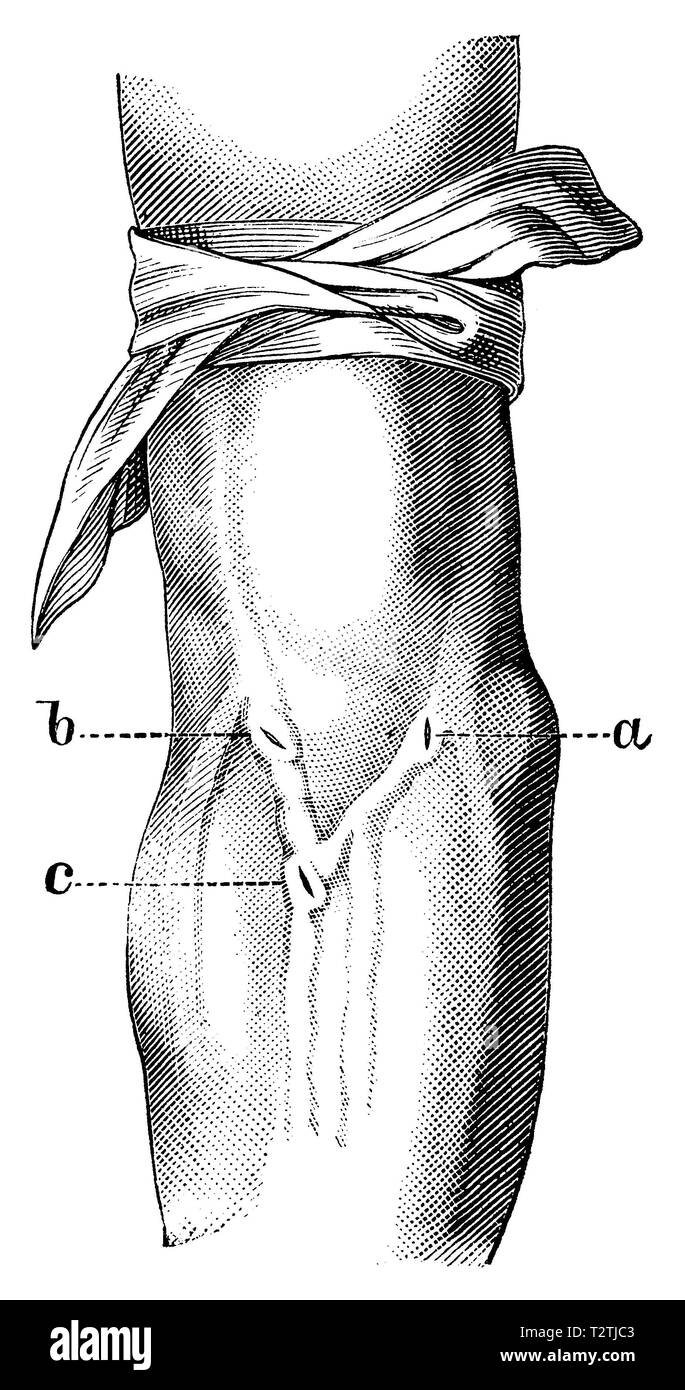 Bloodletting hi-res stock photography and images - Alamy