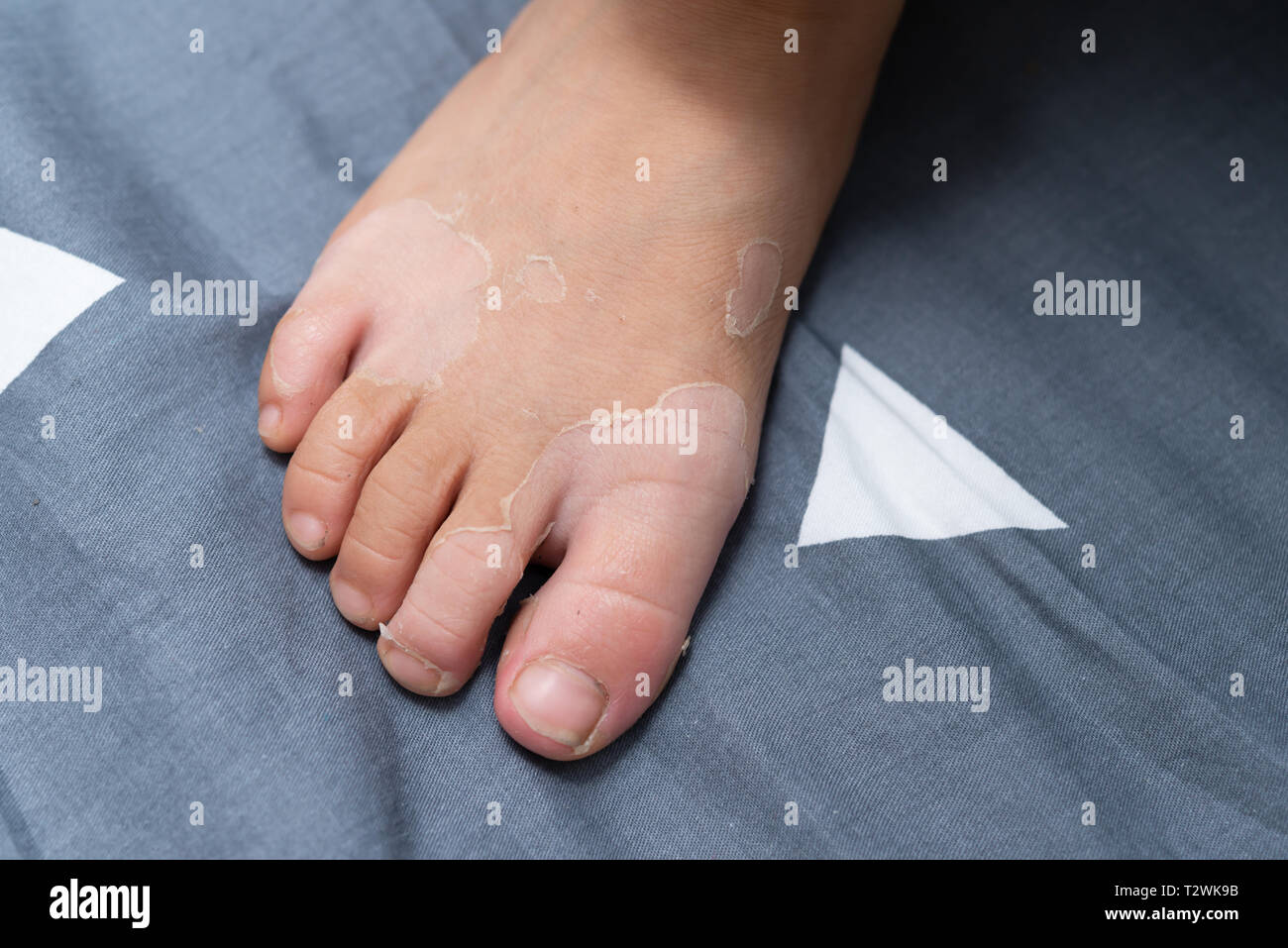 kids foot with old skins coming off Stock Photo - Alamy
