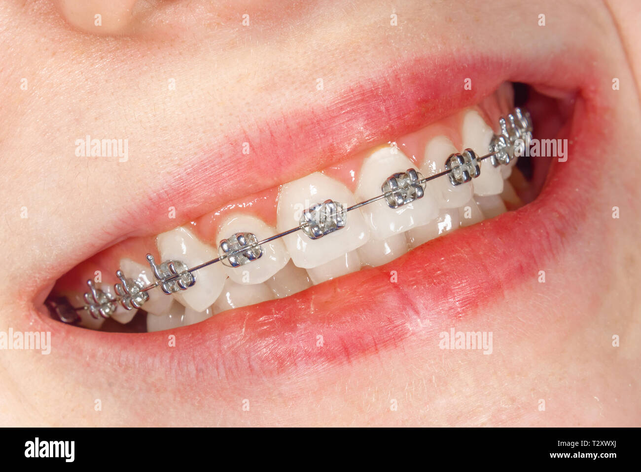 Braces Colors For White Girl