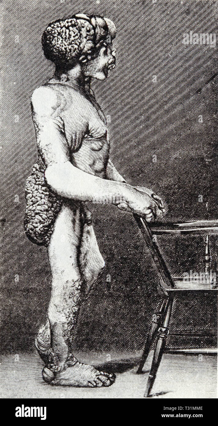 Proteus syndrome hi-res stock photography and images - Alamy