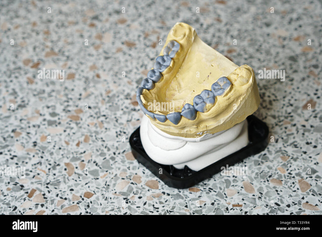 Dental impressions of teeth for manufacture of prostheses and ...