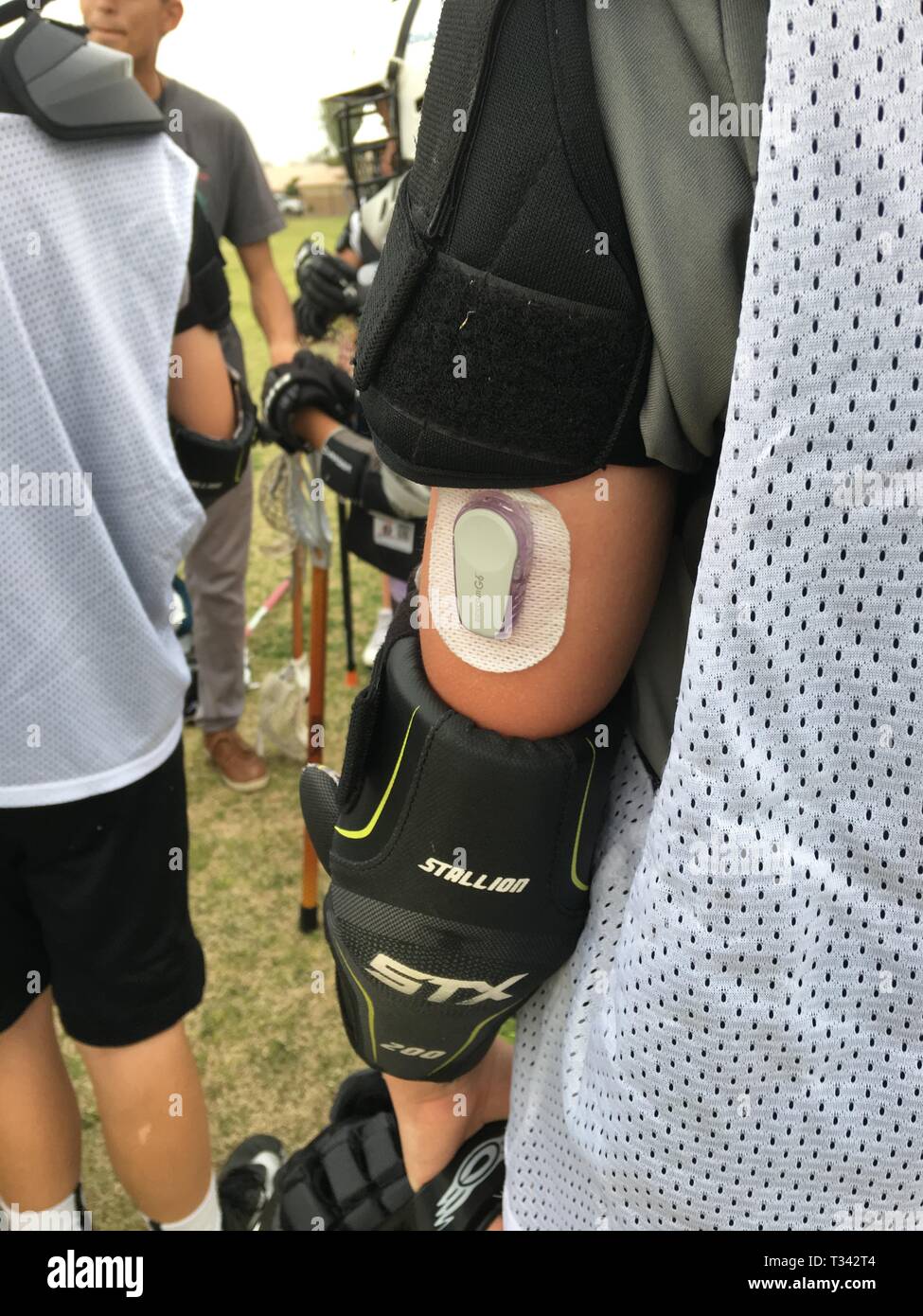 A boy wears a diabetic pod on his arm to deliver insilun while playing ...