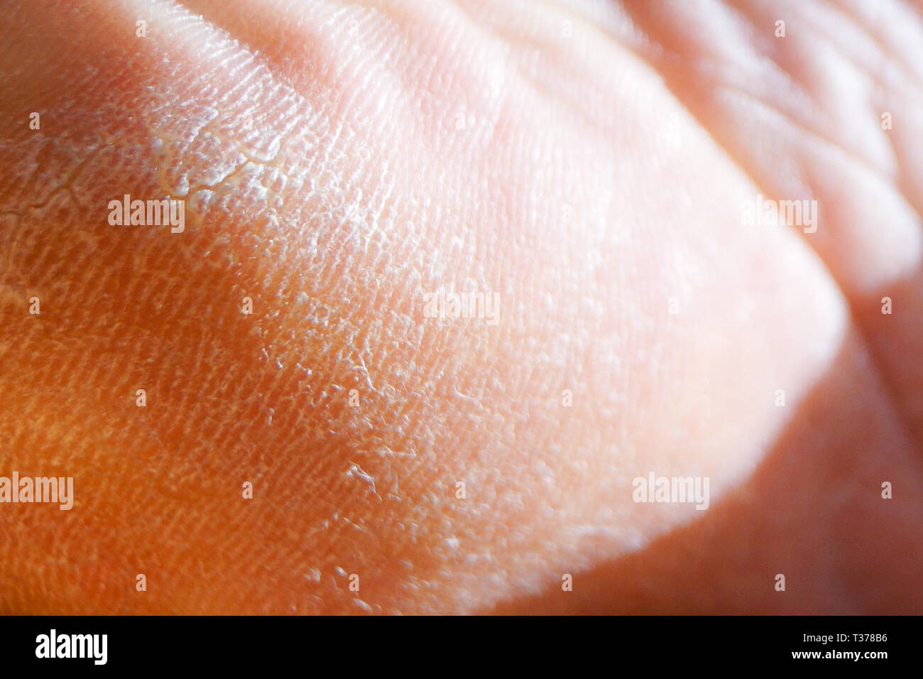 Callus heel hi-res stock photography and images - Alamy