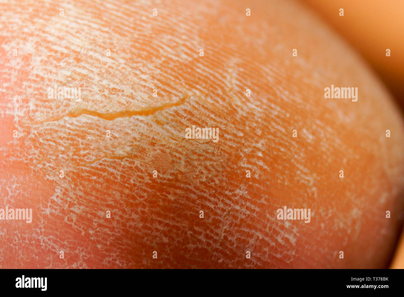 Closeup image of old callus with crack. Image for medical purposes ...