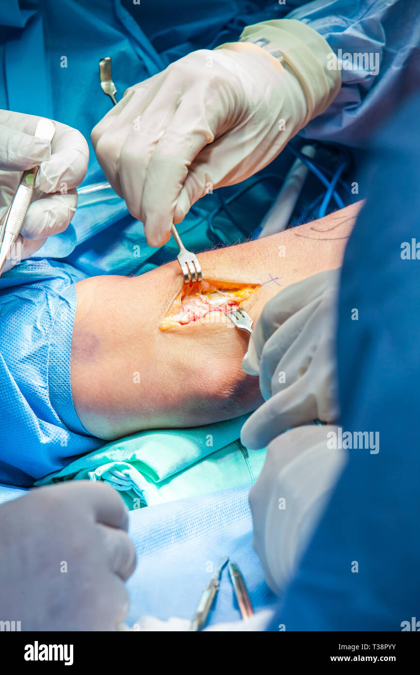 Group of orthopedic surgeons performing surgery on a patient arm Stock ...