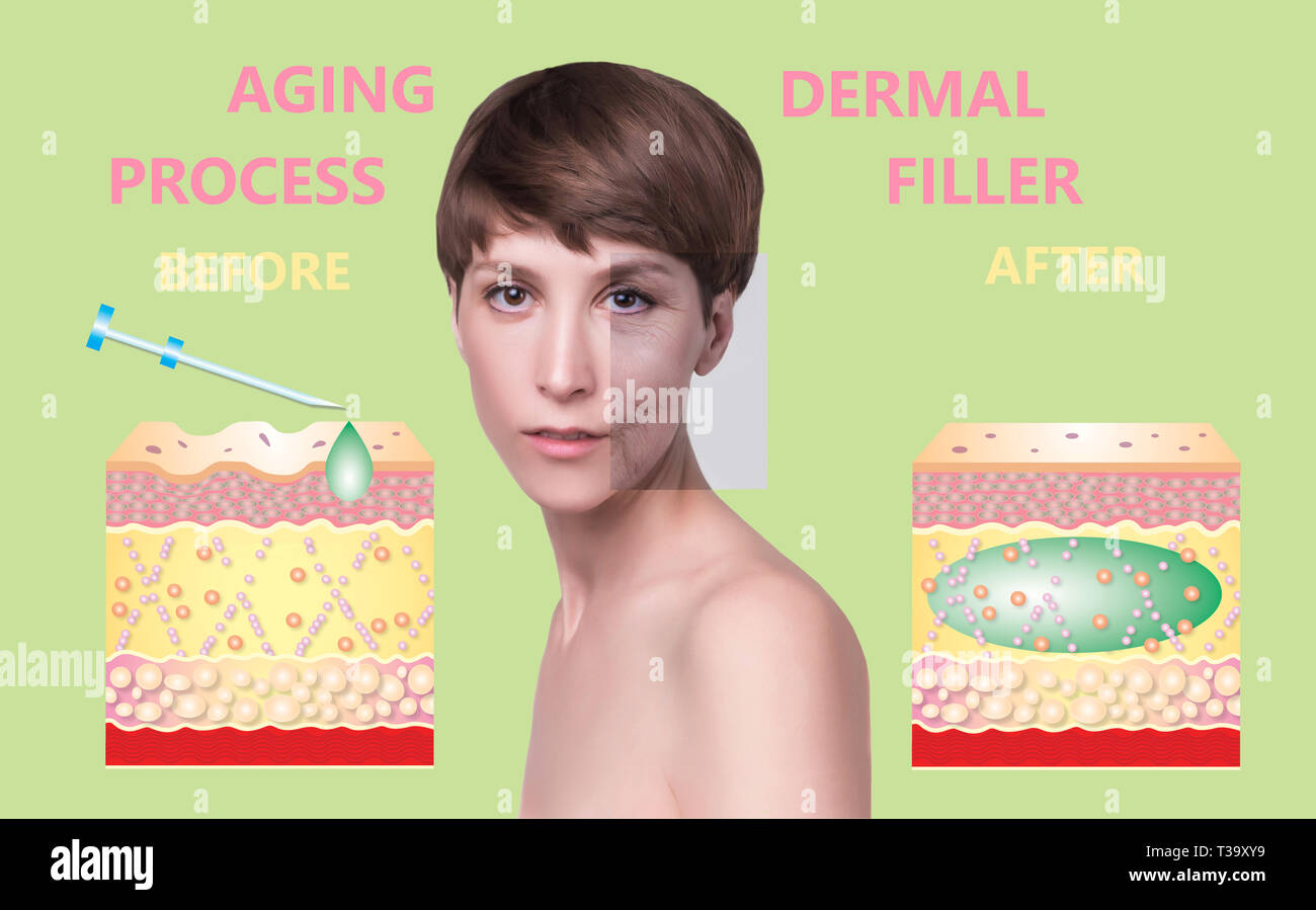 Cosmetic or dermal fillers. Young female with clean fresh skin ...