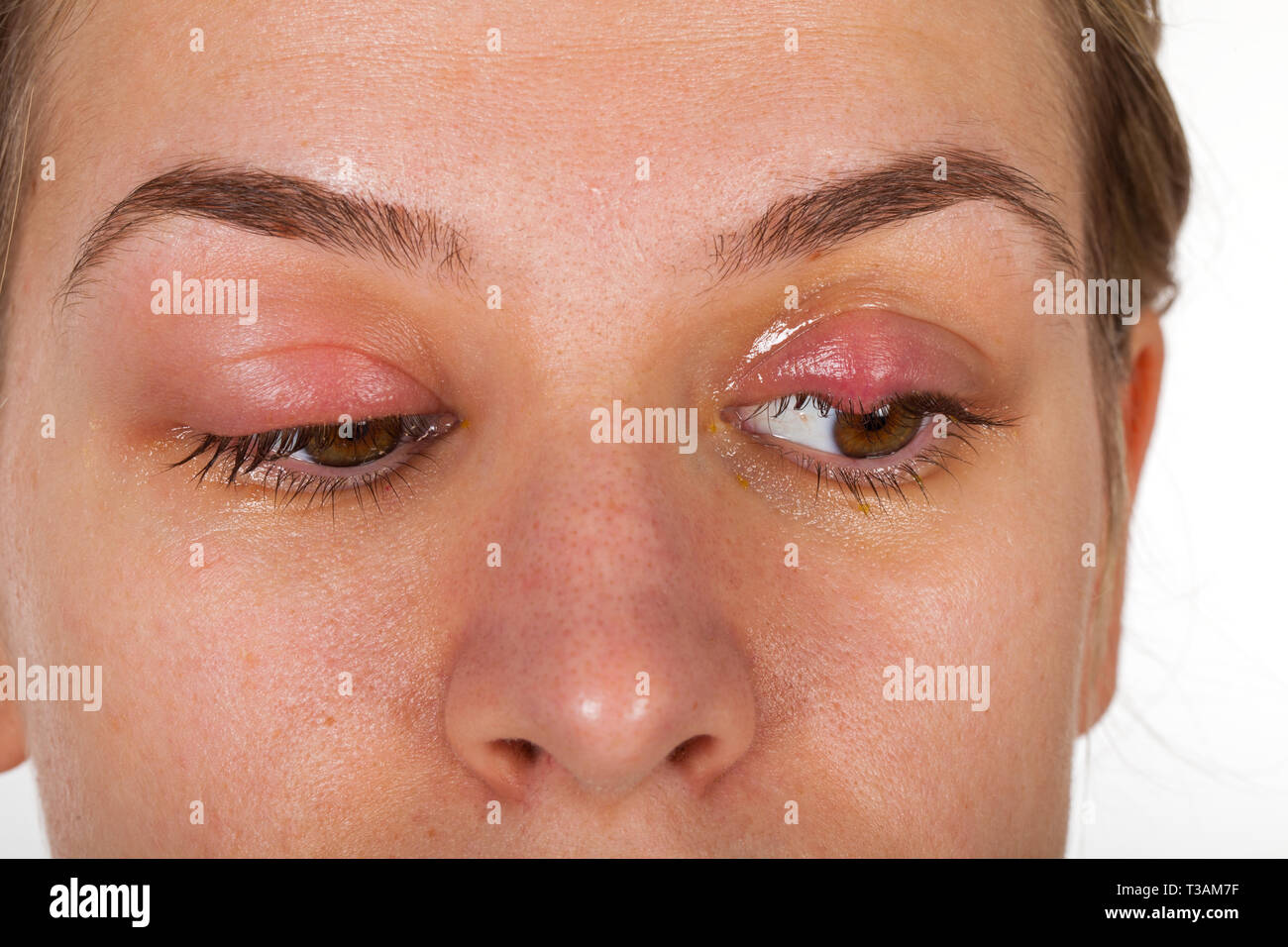 Close up picture of female patient's infected eye. Hordeolum on upper ...