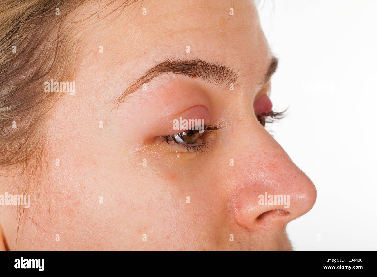 Close up picture of female patient's infected eye. Hordeolum on upper ...
