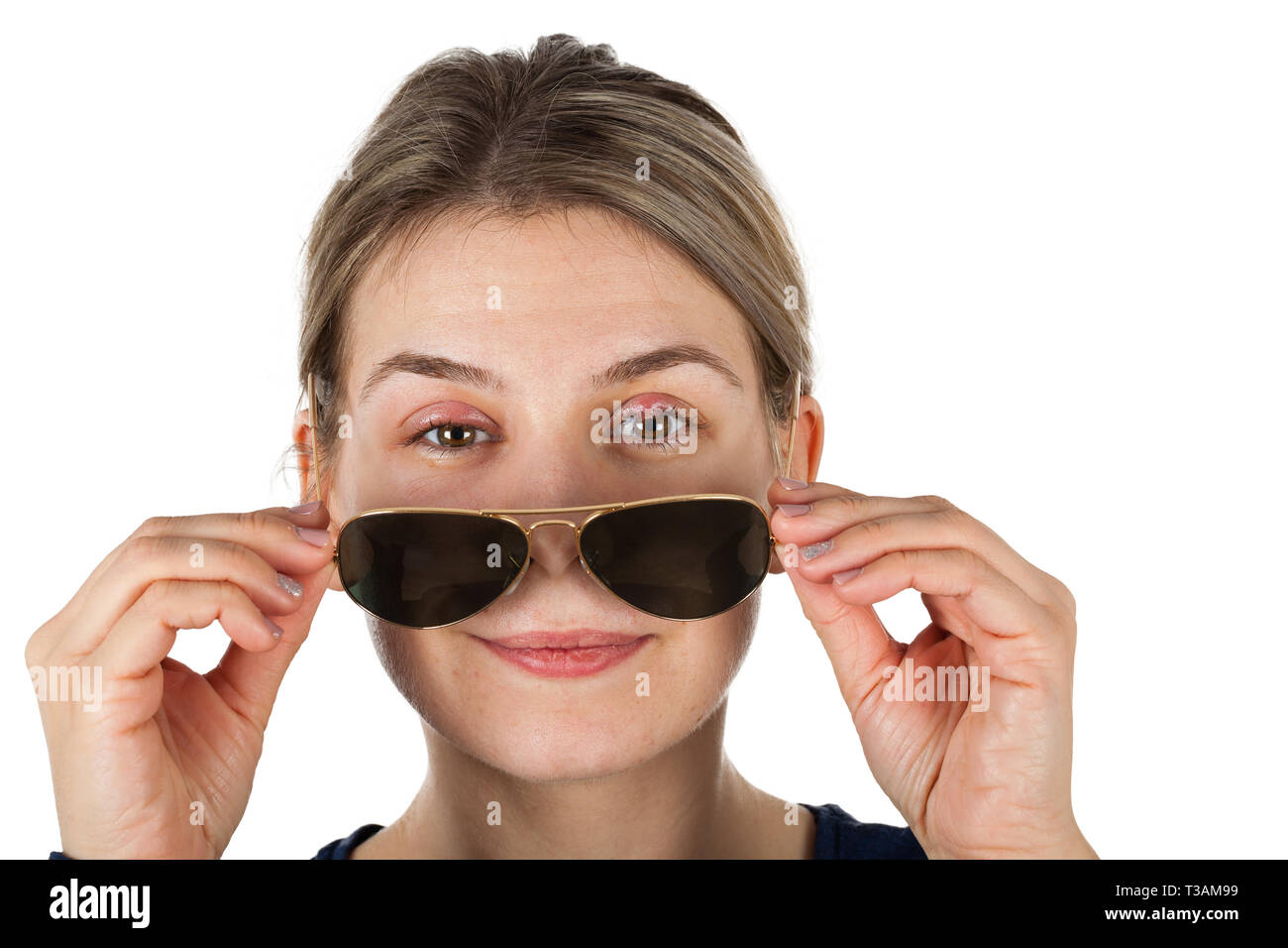 Close up picture of female patient's infected eye. Hordeolum on upper ...