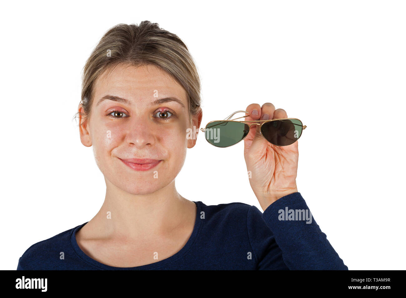 Close up picture of female patient's infected eye. Hordeolum on upper ...