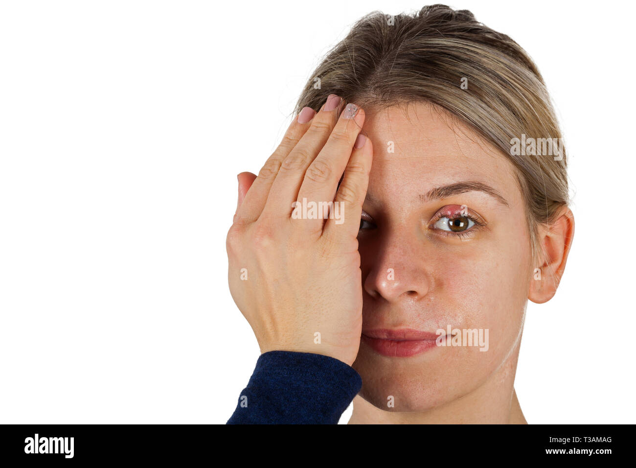 Close up picture of female patient's infected eye. Hordeolum on upper ...