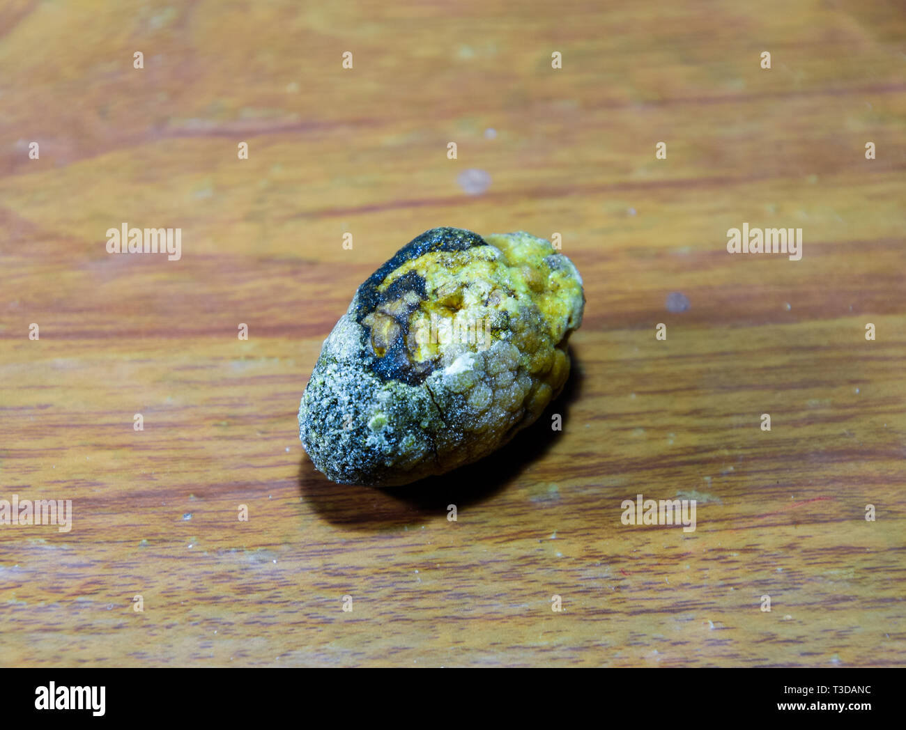 Large gallstone, Gall bladder stone. The result of gallstones. A ...