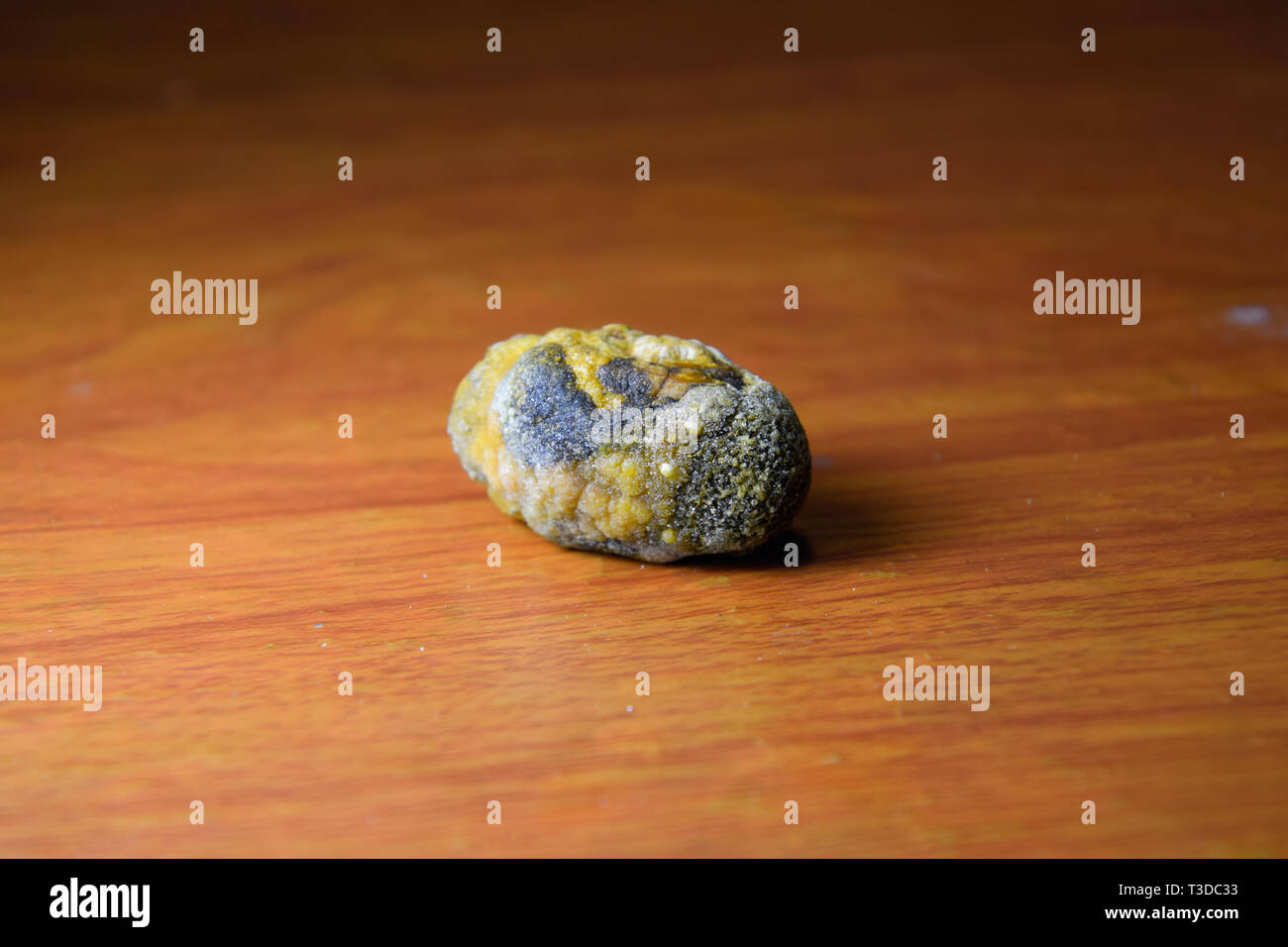 Large gallstone, Gall bladder stone. The result of gallstones. A ...