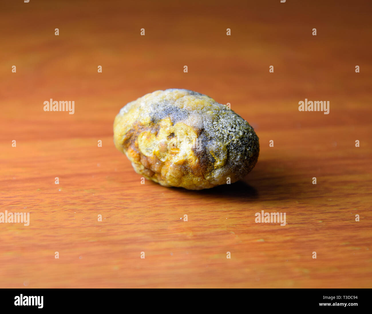 Large gallstone, Gall bladder stone. The result of gallstones. A ...