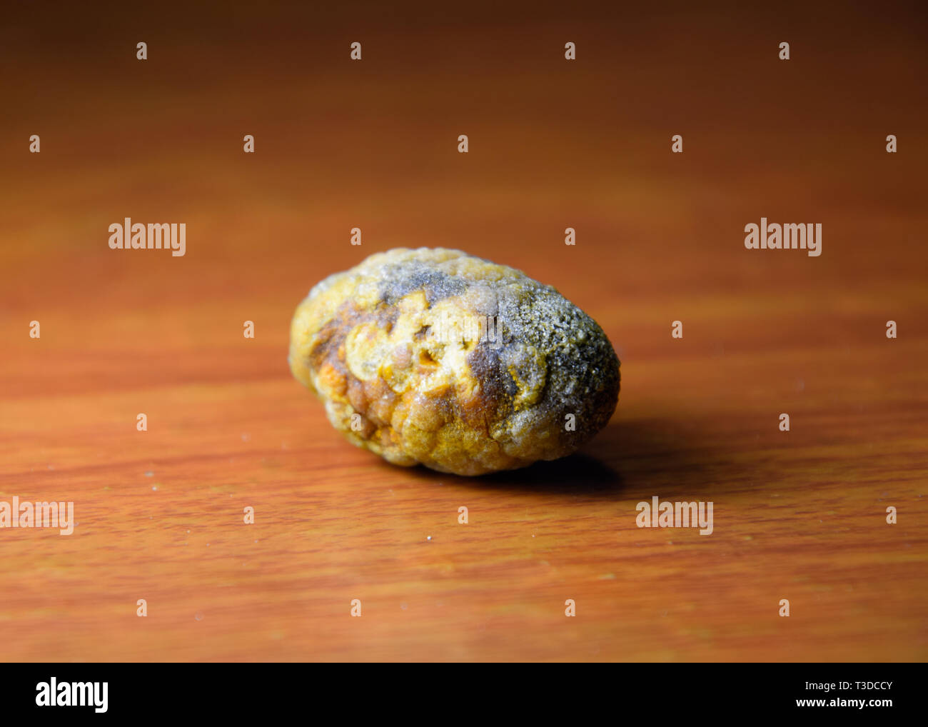 Large gallstone, Gall bladder stone. The result of gallstones. A ...