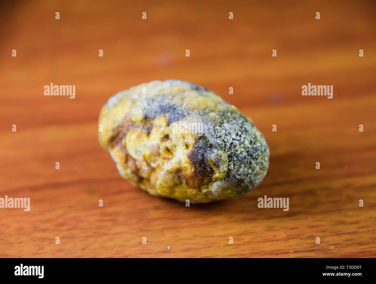 Large gallstone, Gall bladder stone. The result of gallstones. A ...