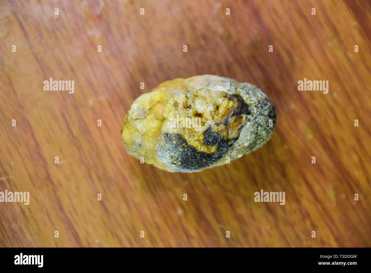 Large gallstone, Gall bladder stone. The result of gallstones. A ...