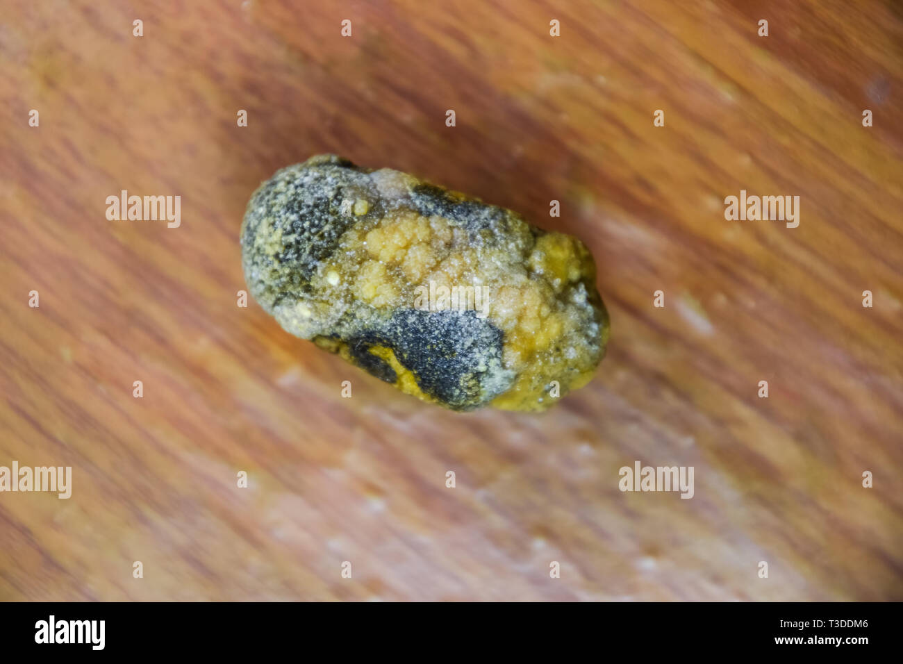 Large gallstone, Gall bladder stone. The result of gallstones. A ...