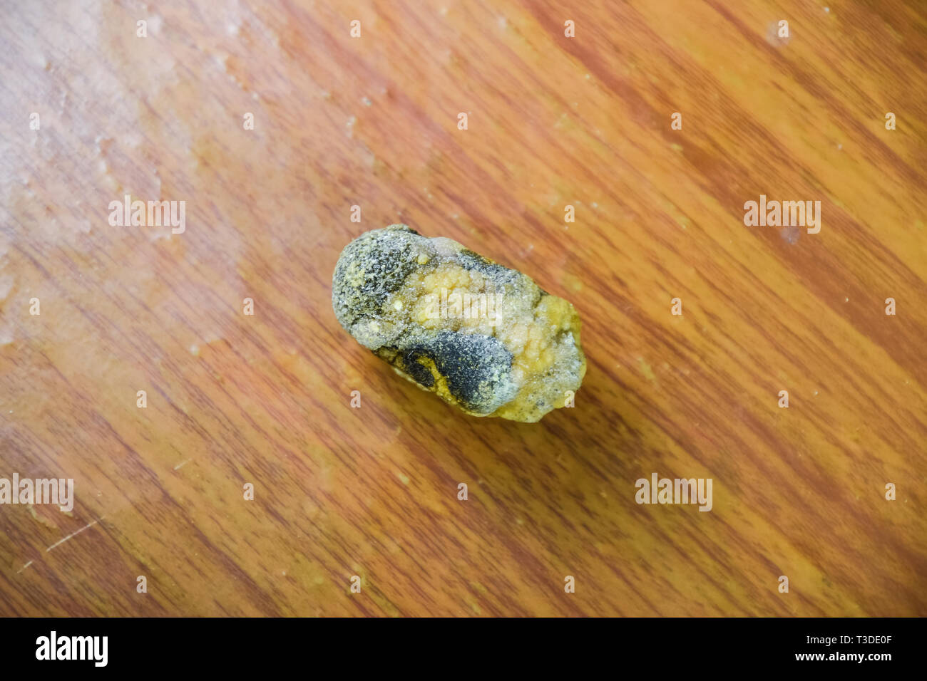 Large gallstone, Gall bladder stone. The result of gallstones. A ...